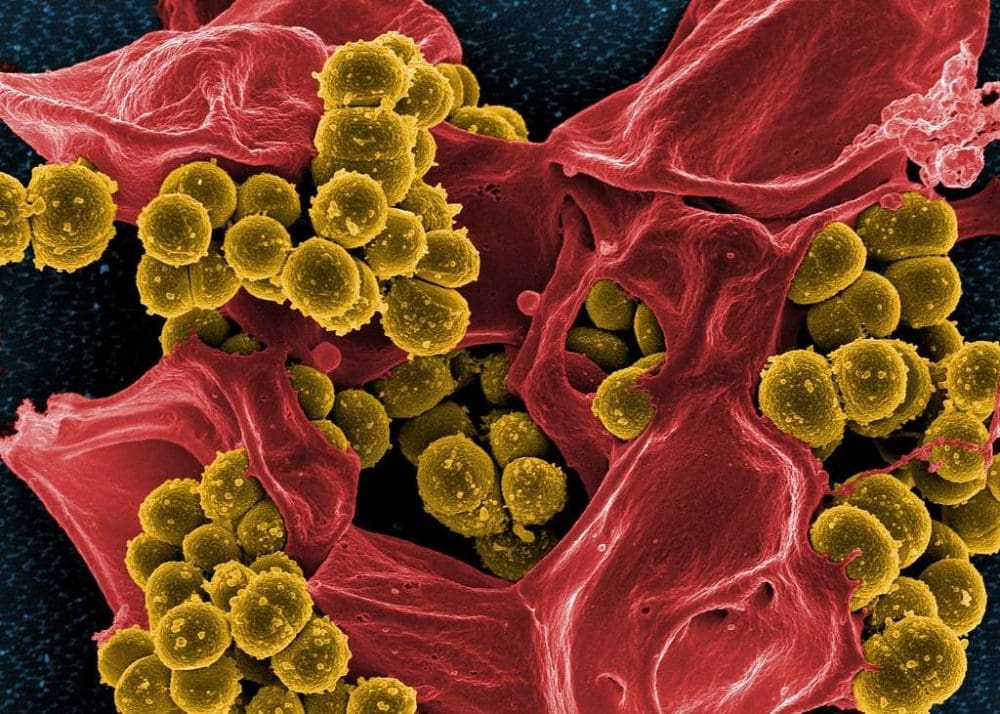 Why Are Sepsis and Staph Infections So Common in Hospitals?